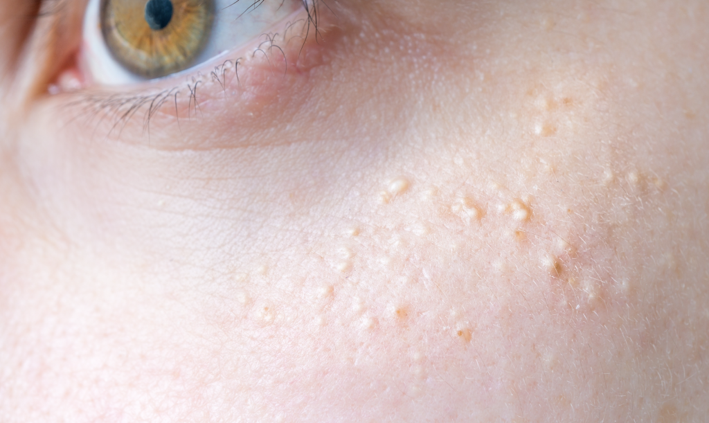 How to Get Rid of Milia - The Dermatology Review